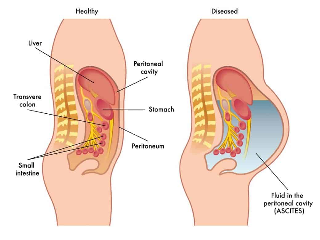 What Is Ascites What Is Ascites