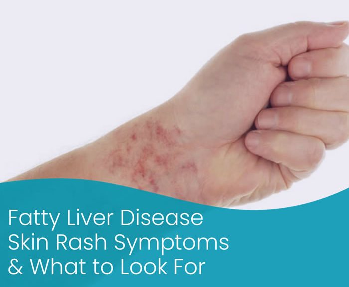 Liver Disease Symptoms Skin Infoupdate
